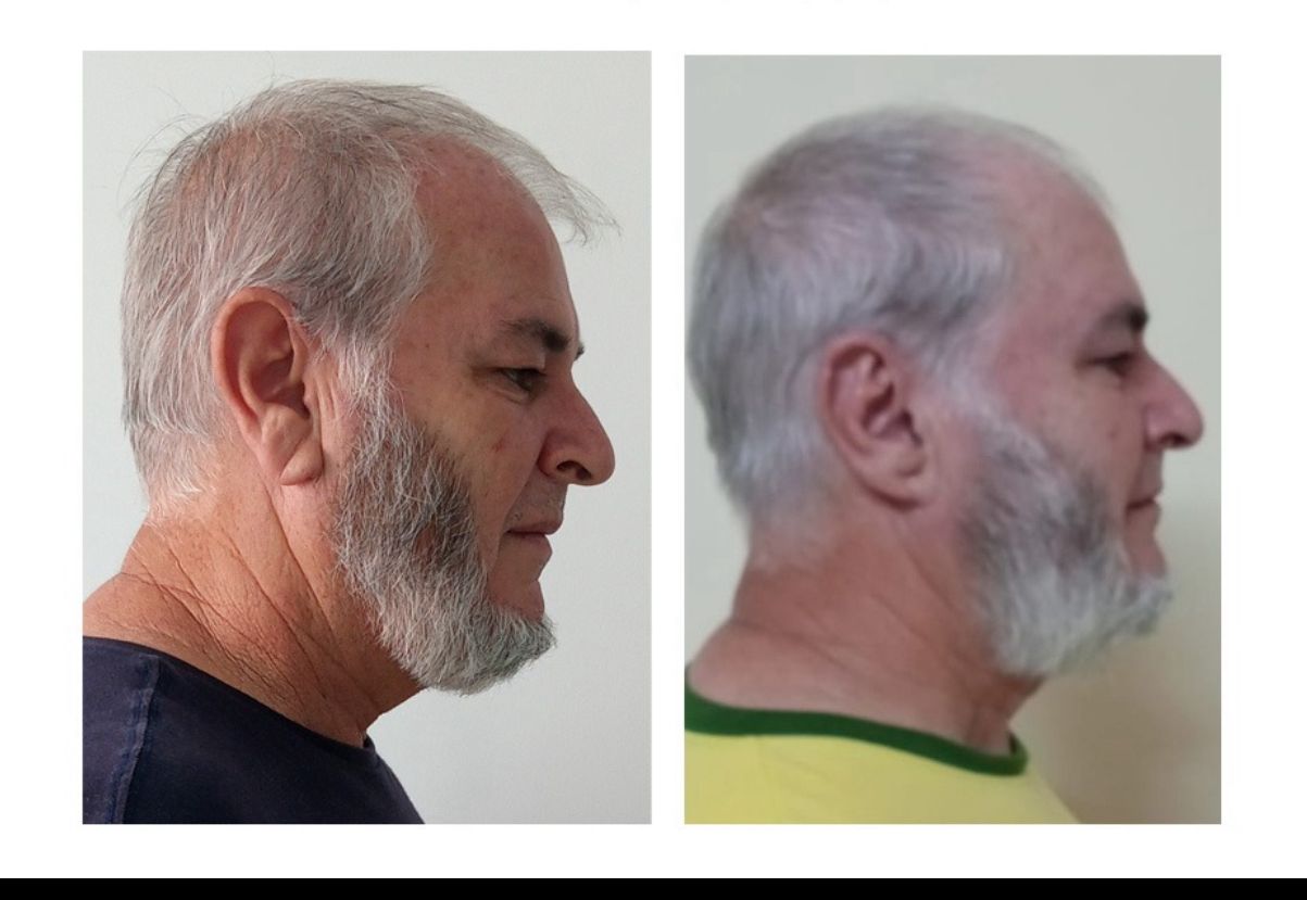 Dr. Marcelo Assis — Cirurgia de Macrotia